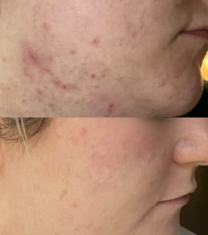 PCOS Acne treatment – Skin Clinic Bolton | HIFU, RF Microneedling, Skin ...