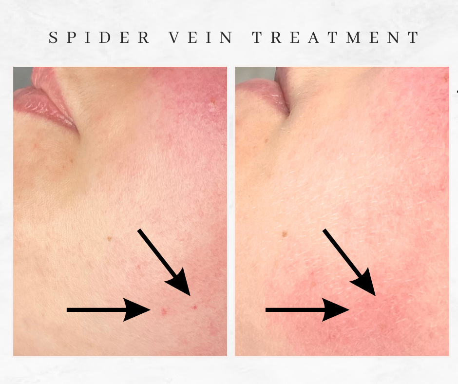 Thread Vein Removal - Spider Vein Removal - Loud Skin Clinic ...