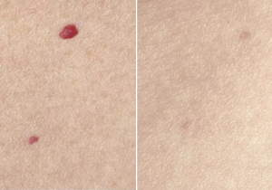 Cherry Angioma Removal – Skin Clinic Bolton | HIFU, RF Microneedling ...