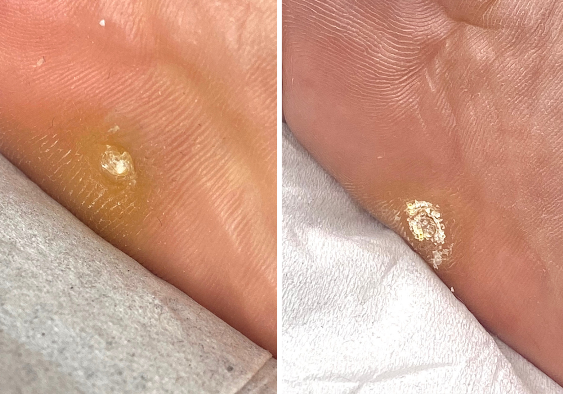 Wart Treatment - Loud Skin Clinic Westhoughton, Bolton | Advanced ...