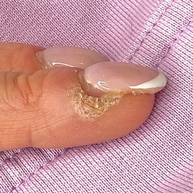 Wart Treatment - Loud Skin Clinic Westhoughton, Bolton | Advanced ...
