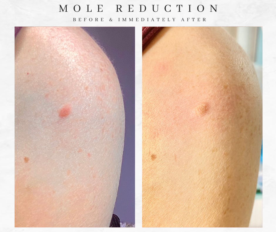 Mole Treatment - Loud Skin Clinic Westhoughton, Bolton | Advanced ...