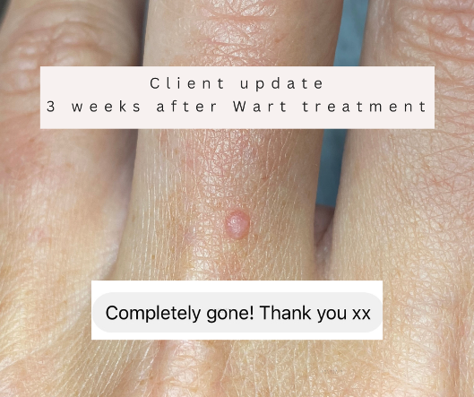 Wart Treatment – Skin Clinic Bolton | HIFU, RF Microneedling, Skin Tag ...