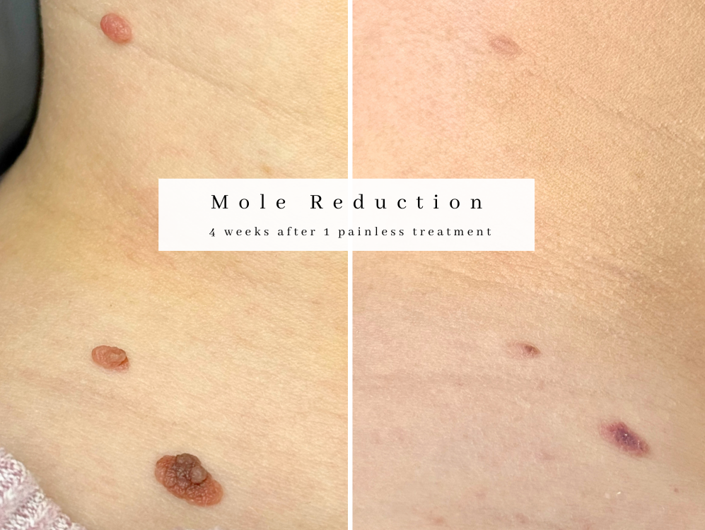 Mole Treatment – Skin Clinic Bolton | HIFU, RF Microneedling, Skin Tag ...